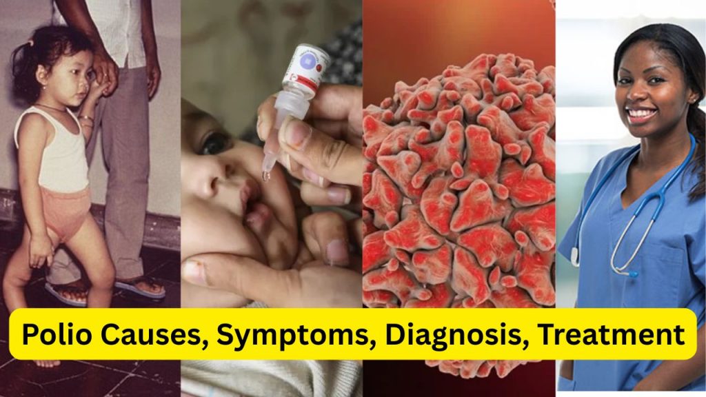 Understanding Polio: Causes, Symptoms, Prevention, and Treatment - Dr ...