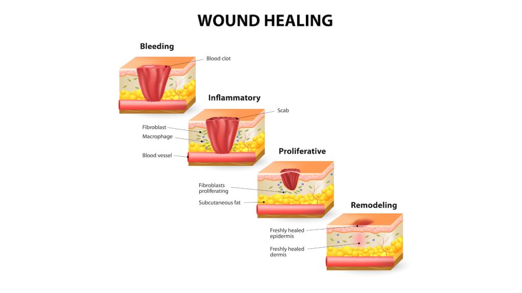 Wounds and gangrene, general principle of management of wounds, wounds ...
