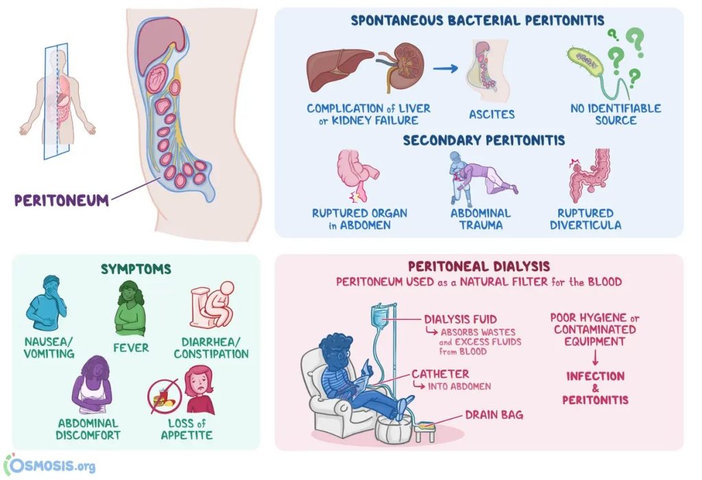 Peritonitis and bowel obstruction Lecture Presentation :causes ...