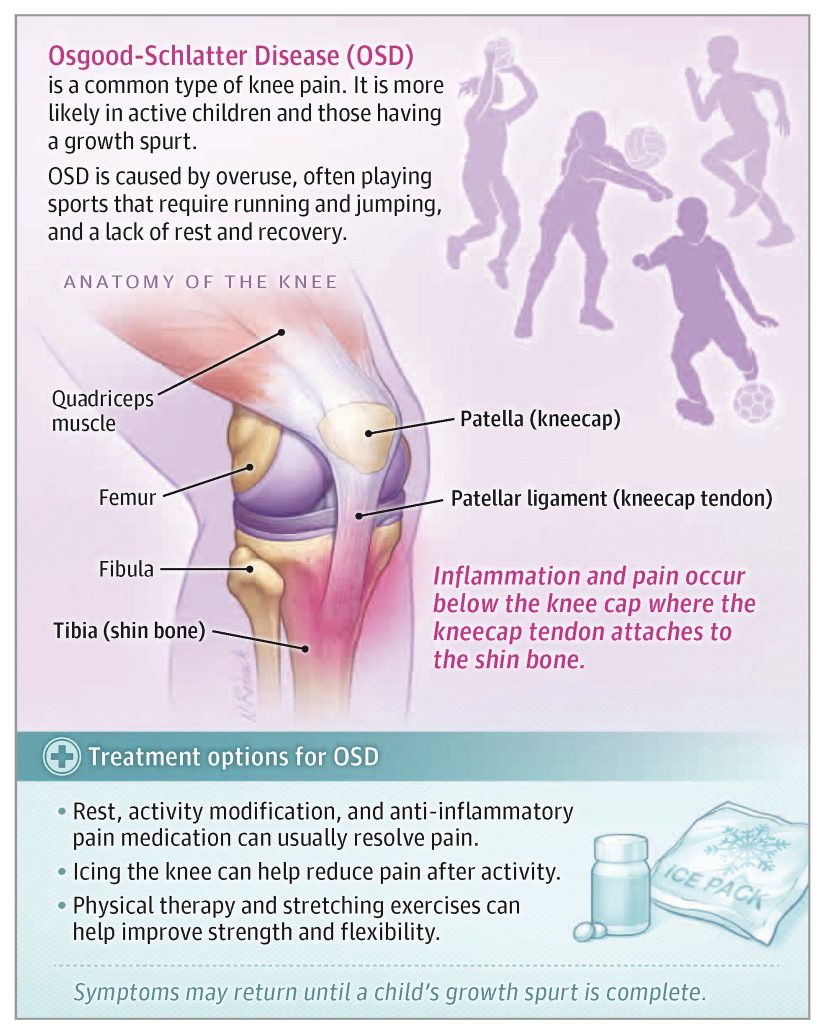 Osgood-Schlatter Disease (OSD) - Dr Chaitanya Joshi, MD