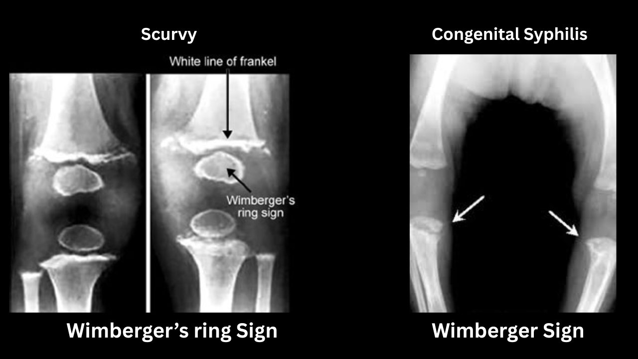 Wimberger’s Sign vs Wimberger Ring Sign A comparison - Dr Chaitanya ...