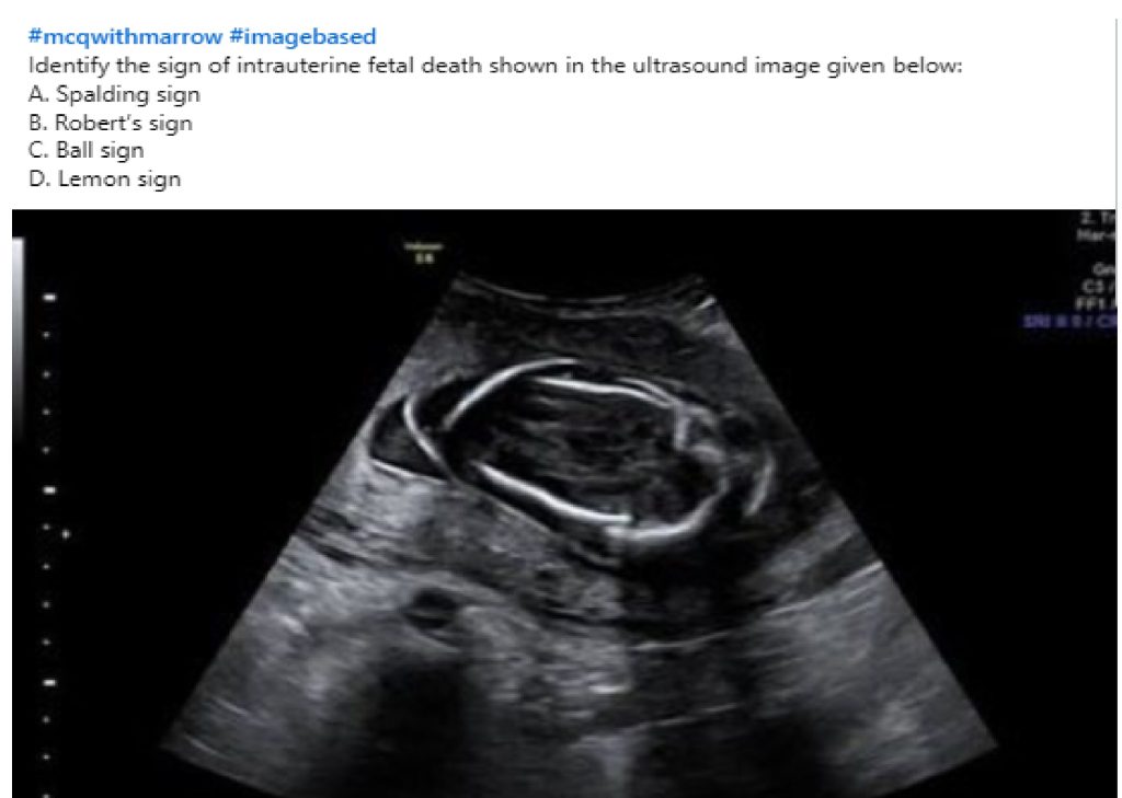 Intrauterine Fetal Death (IUFD) — Diagnosis & High-Yield Points - Dr ...